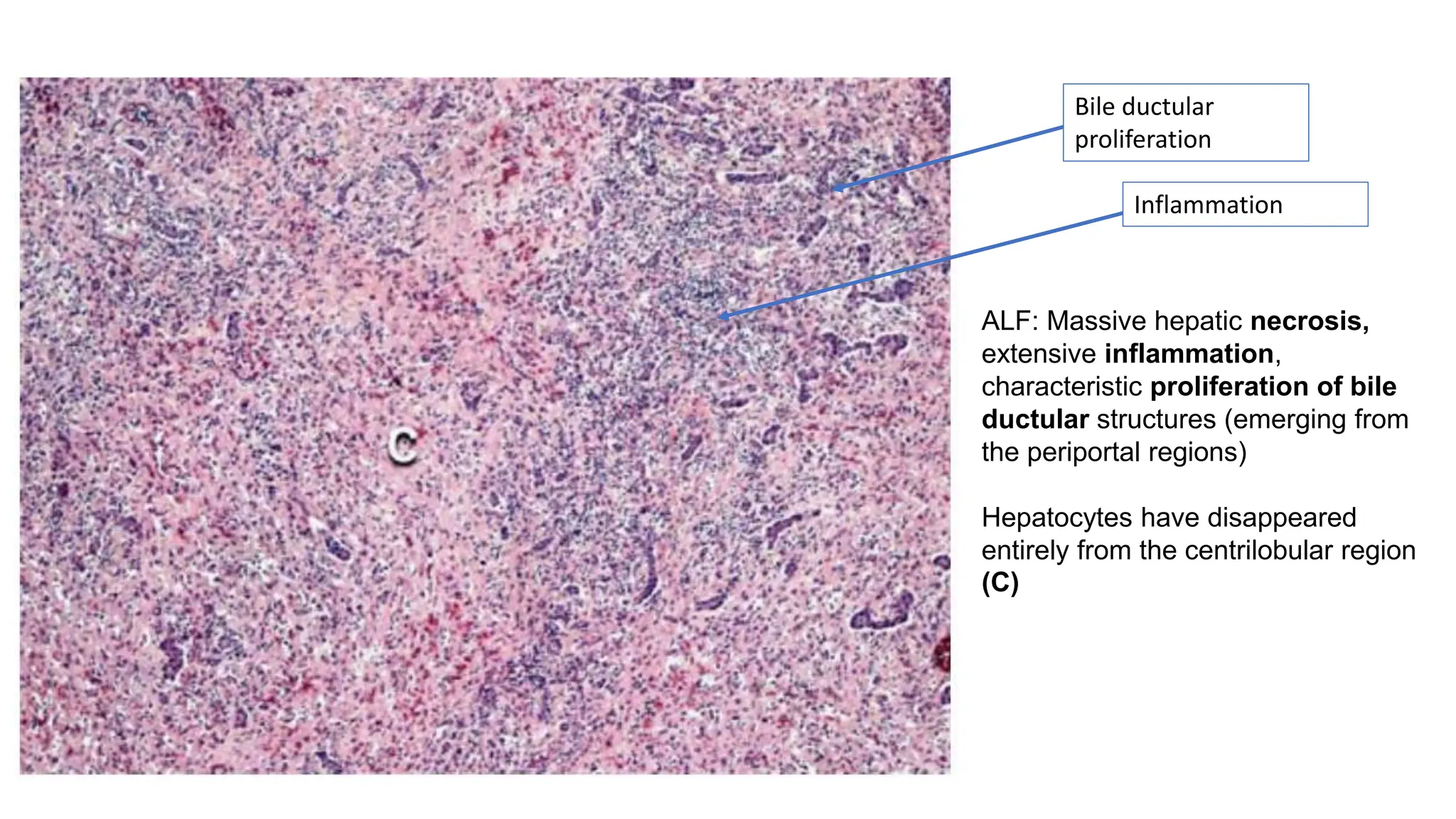 Presentation on acute liver failure.pptx