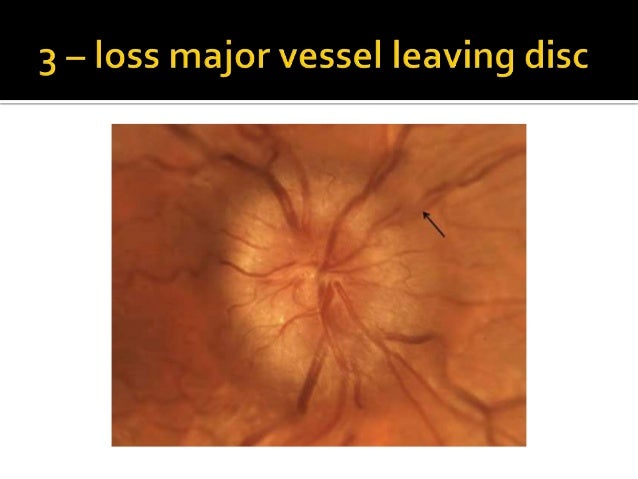 Elevated optic discs - Are they ever benign?