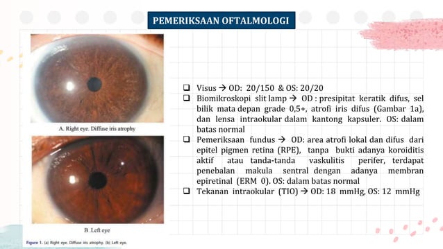 JR Mata Kelompok B_Uveitis Kronik Pada Kusta.pptx