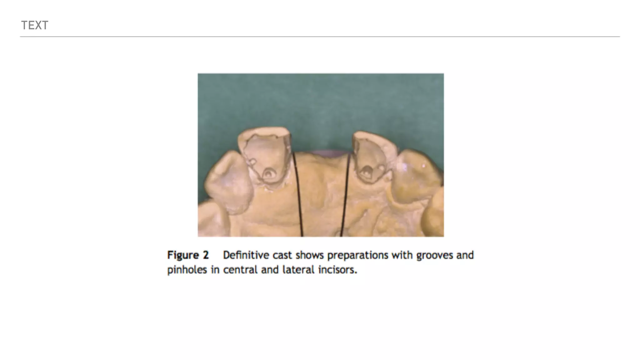 Prosthodontics: Maryland Bridge | PDF