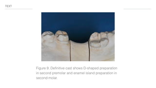 Prosthodontics: Maryland Bridge | PDF