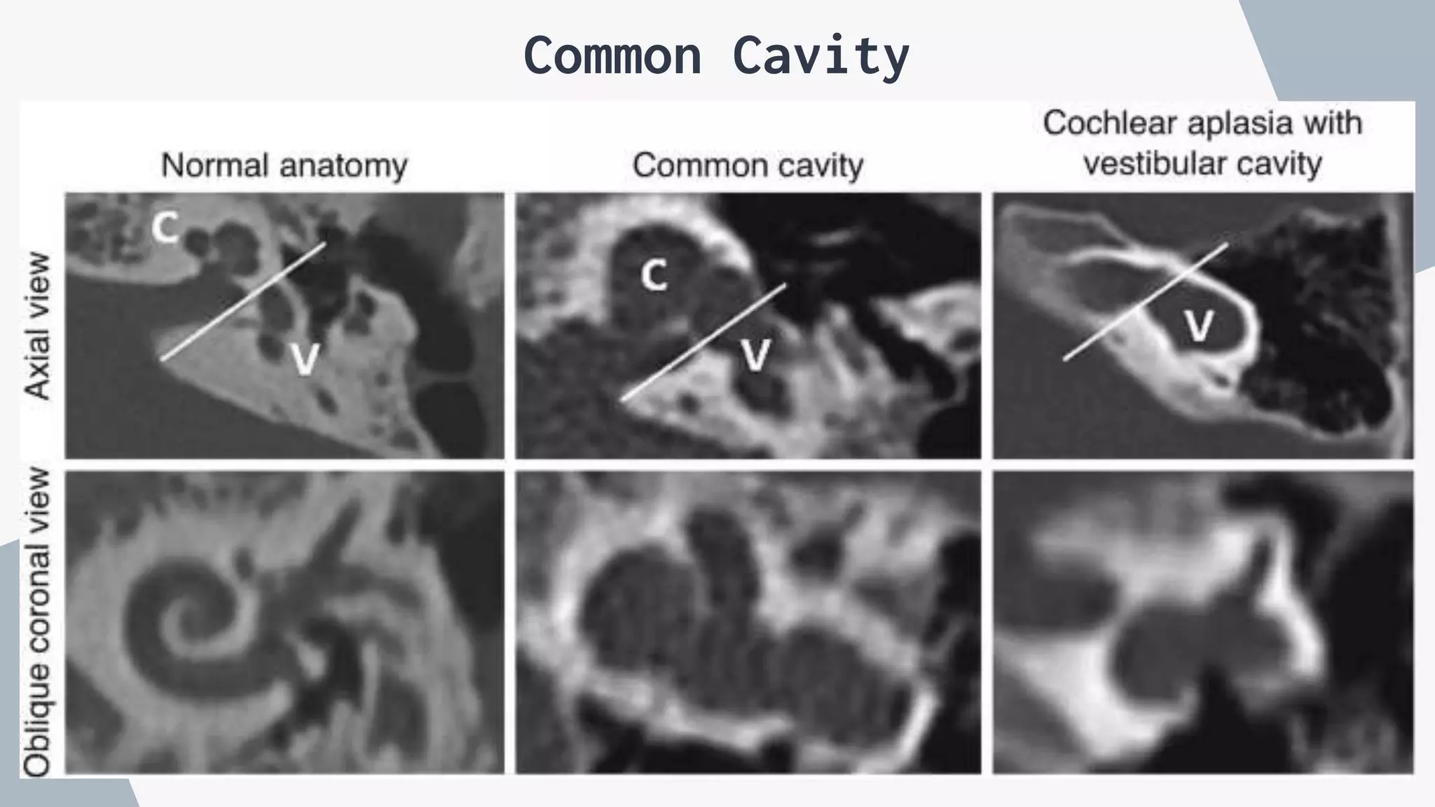 Pre post operative imaging of cochlear implant.pptx