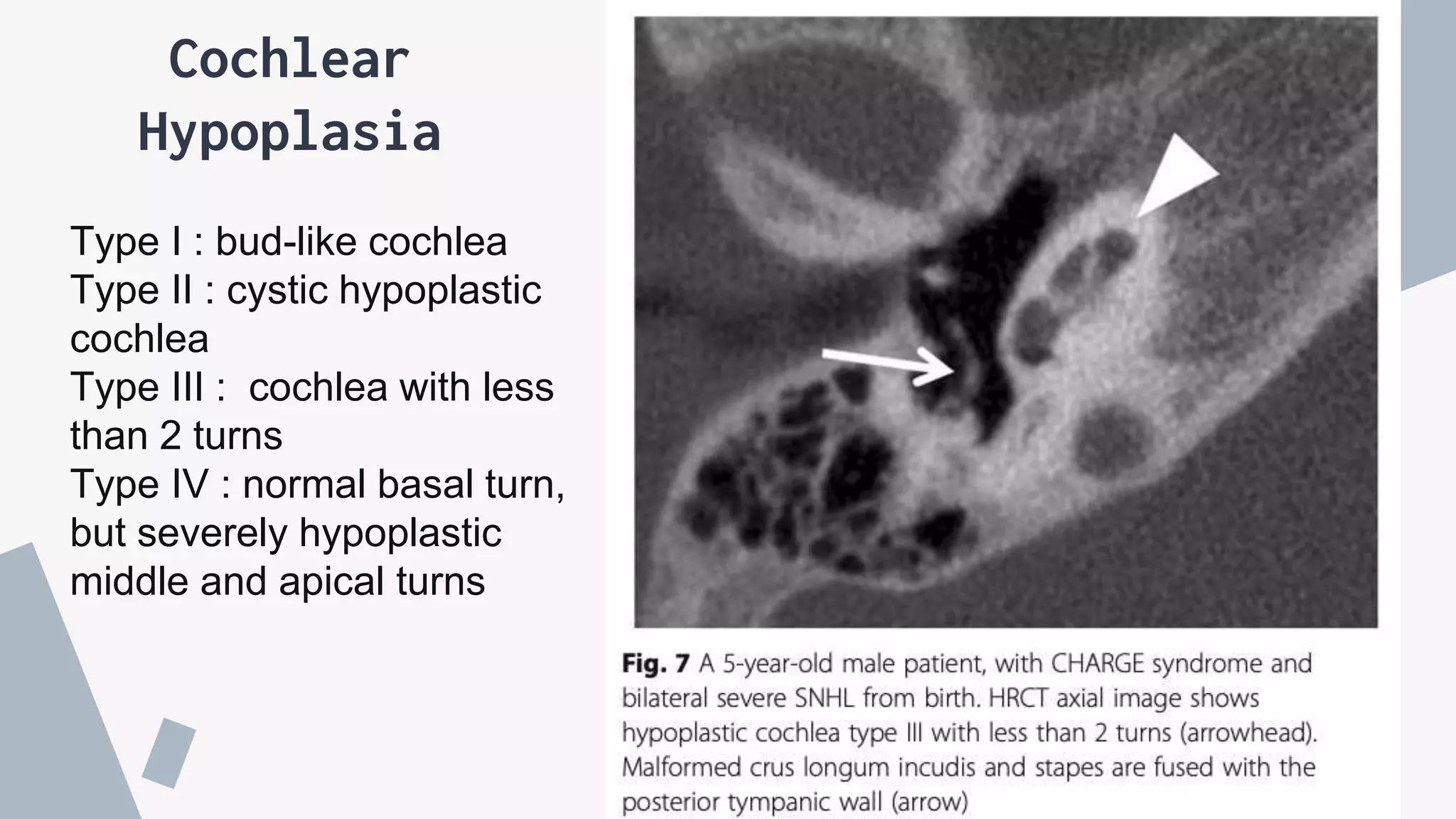 Pre post operative imaging of cochlear implant.pptx