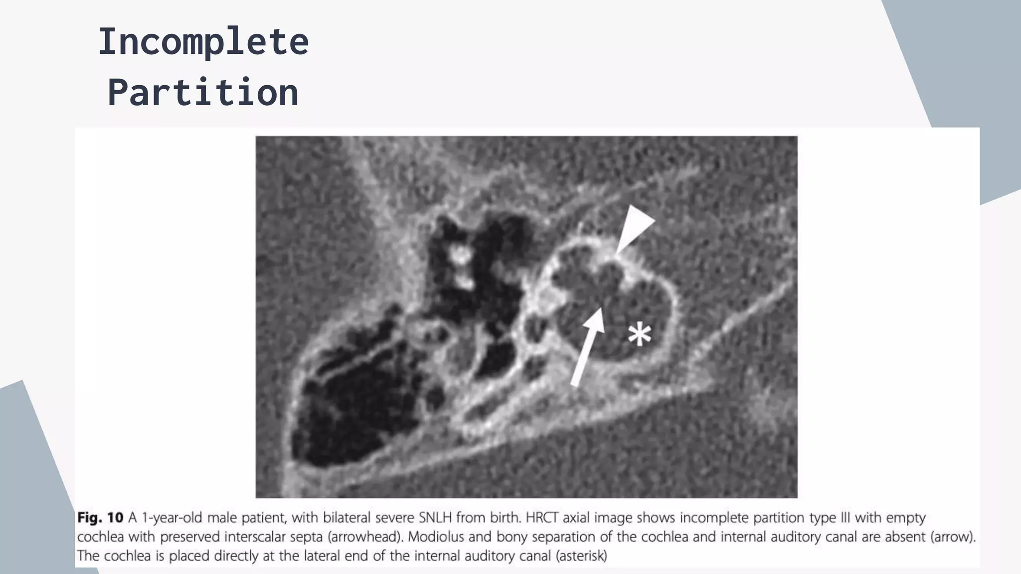 Pre post operative imaging of cochlear implant.pptx