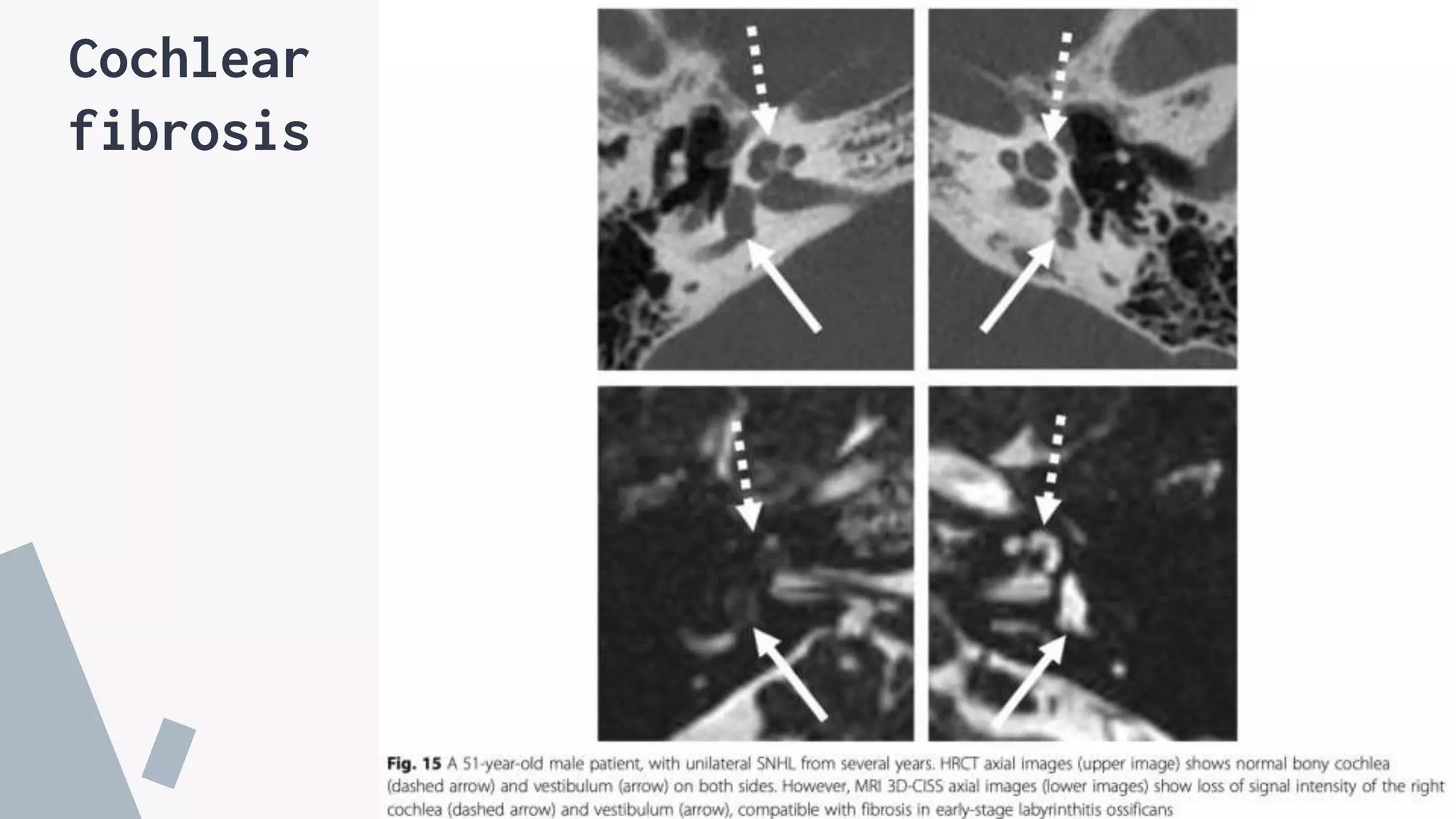 Pre post operative imaging of cochlear implant.pptx