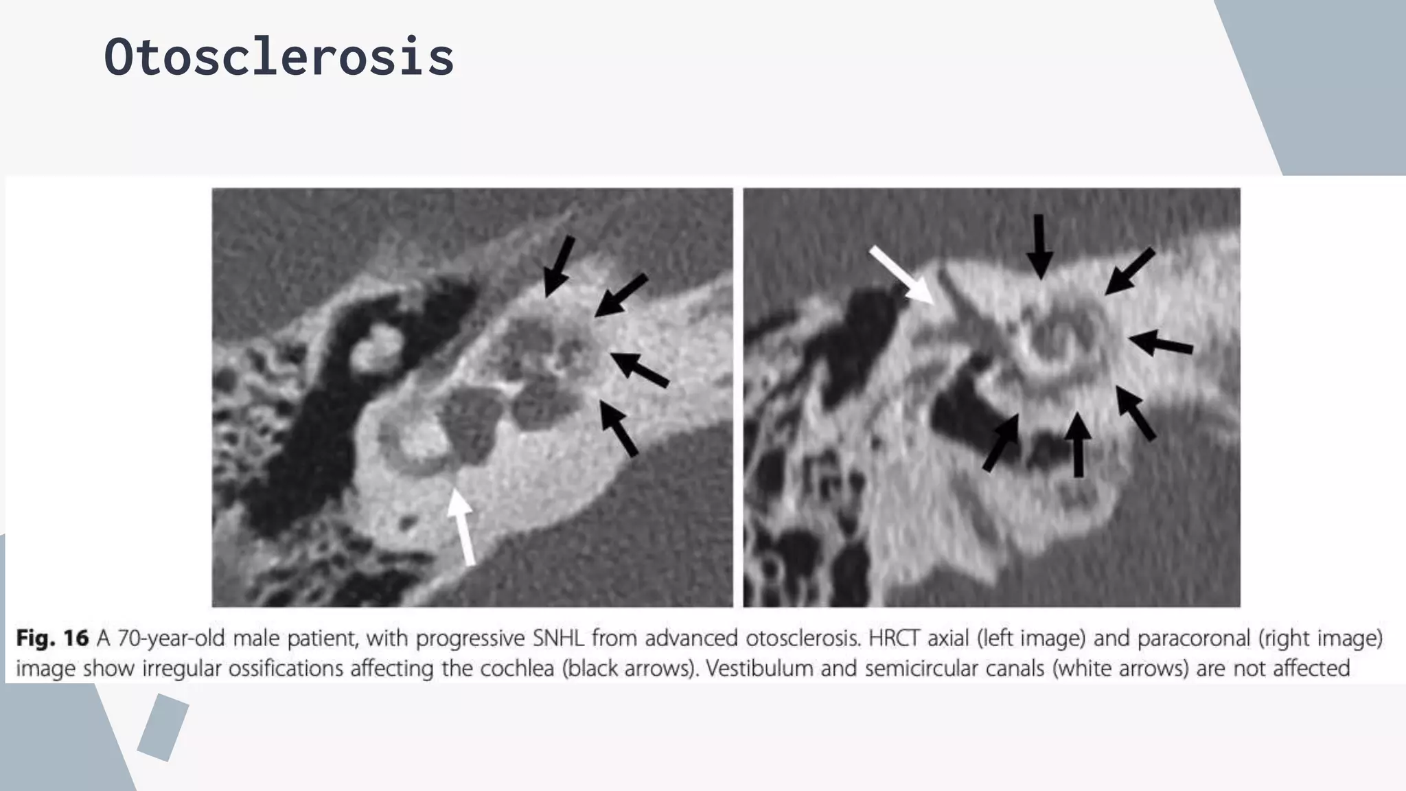 Pre post operative imaging of cochlear implant.pptx