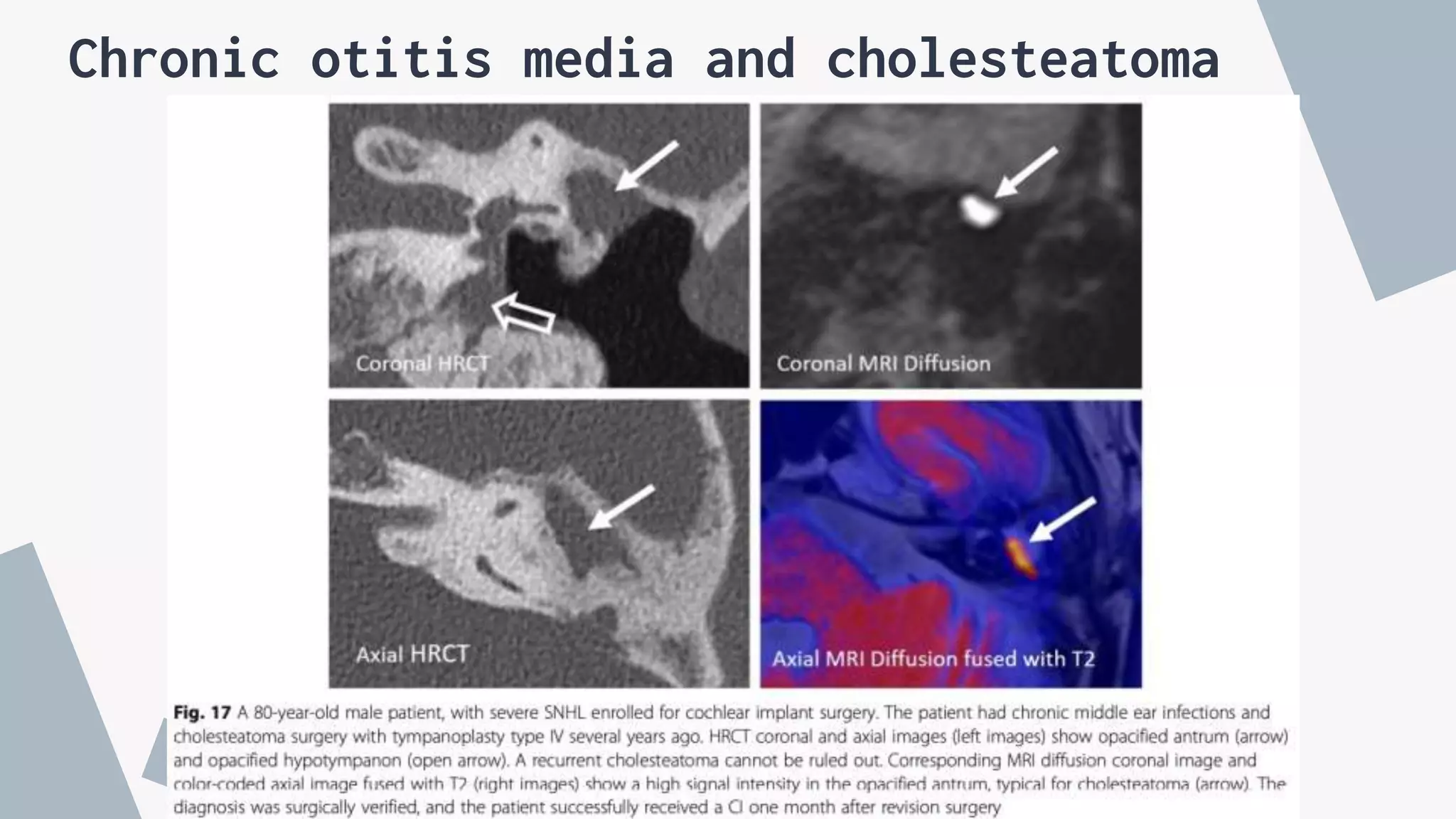 Pre post operative imaging of cochlear implant.pptx