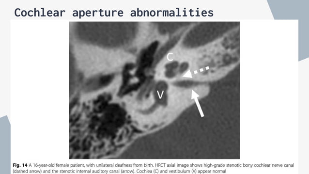 Pre post operative imaging of cochlear implant.pptx