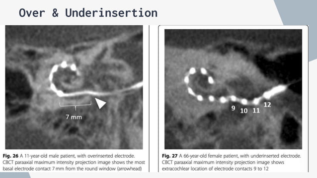 Pre post operative imaging of cochlear implant.pptx