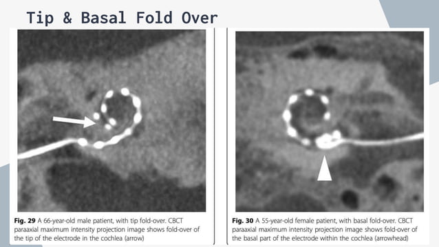 Pre post operative imaging of cochlear implant.pptx