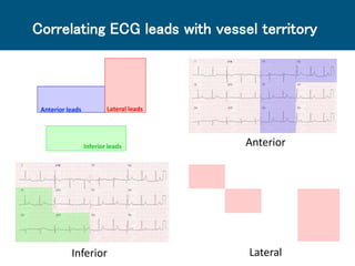ECG interpretation in NSTEMI | PPTX