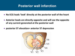 ECG interpretation in NSTEMI | PPTX