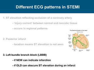 ECG interpretation in NSTEMI | PPTX