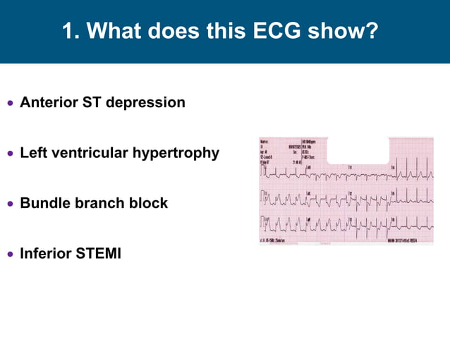 ECG interpretation in NSTEMI | PPTX