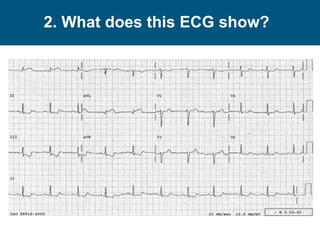 ECG interpretation in NSTEMI | PPTX