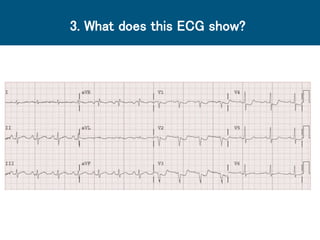 ECG interpretation in NSTEMI | PPTX