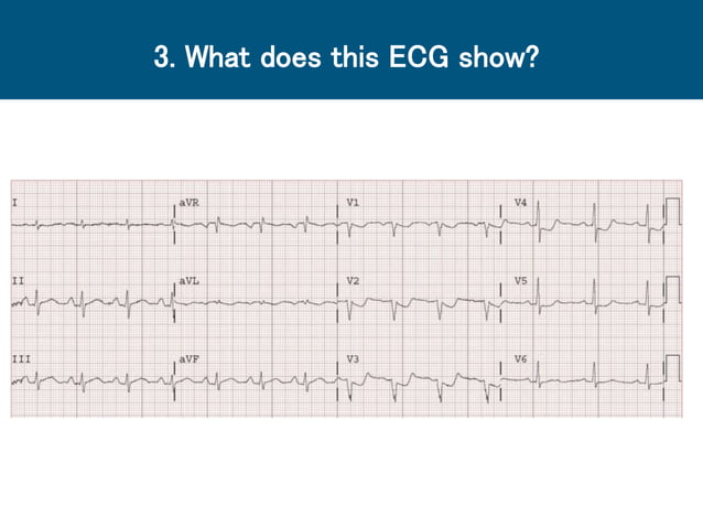 ECG interpretation in NSTEMI | PPTX