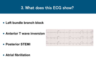 ECG interpretation in NSTEMI | PPTX