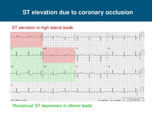 ECG interpretation in NSTEMI