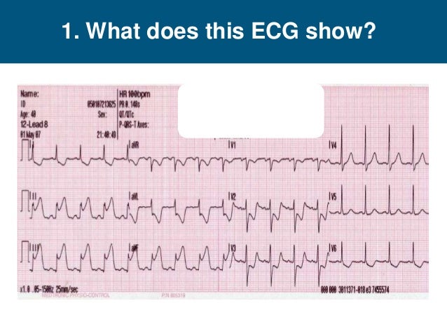 ECG interpretation in NSTEMI