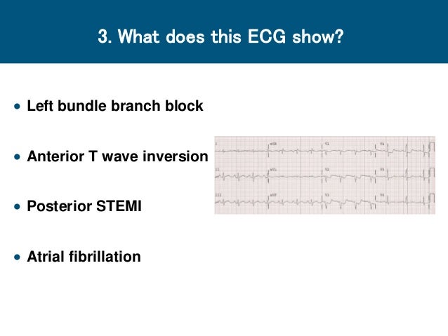 ECG interpretation in NSTEMI