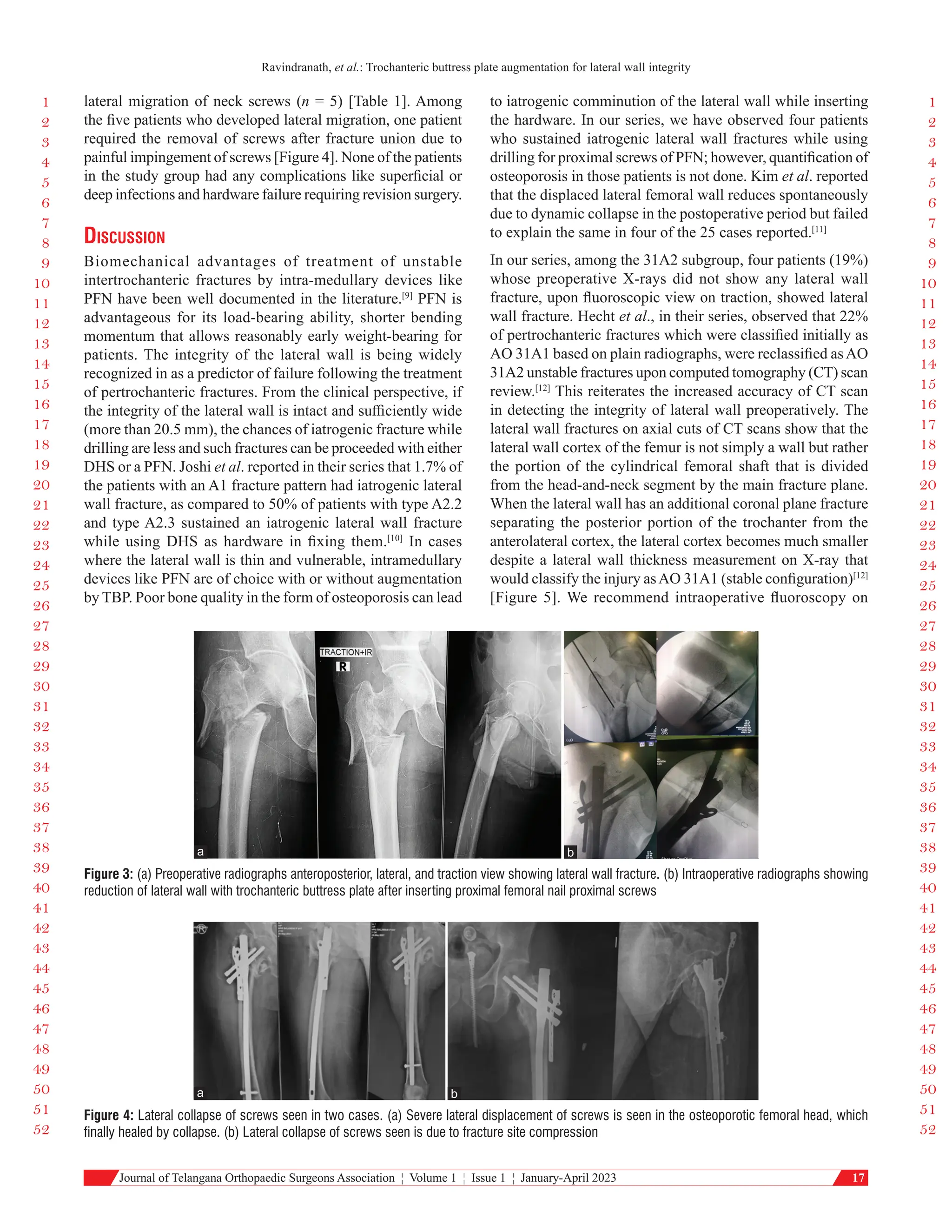 Trochanteric buttress plate augmentation | PDF