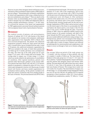 Trochanteric buttress plate augmentation | PDF