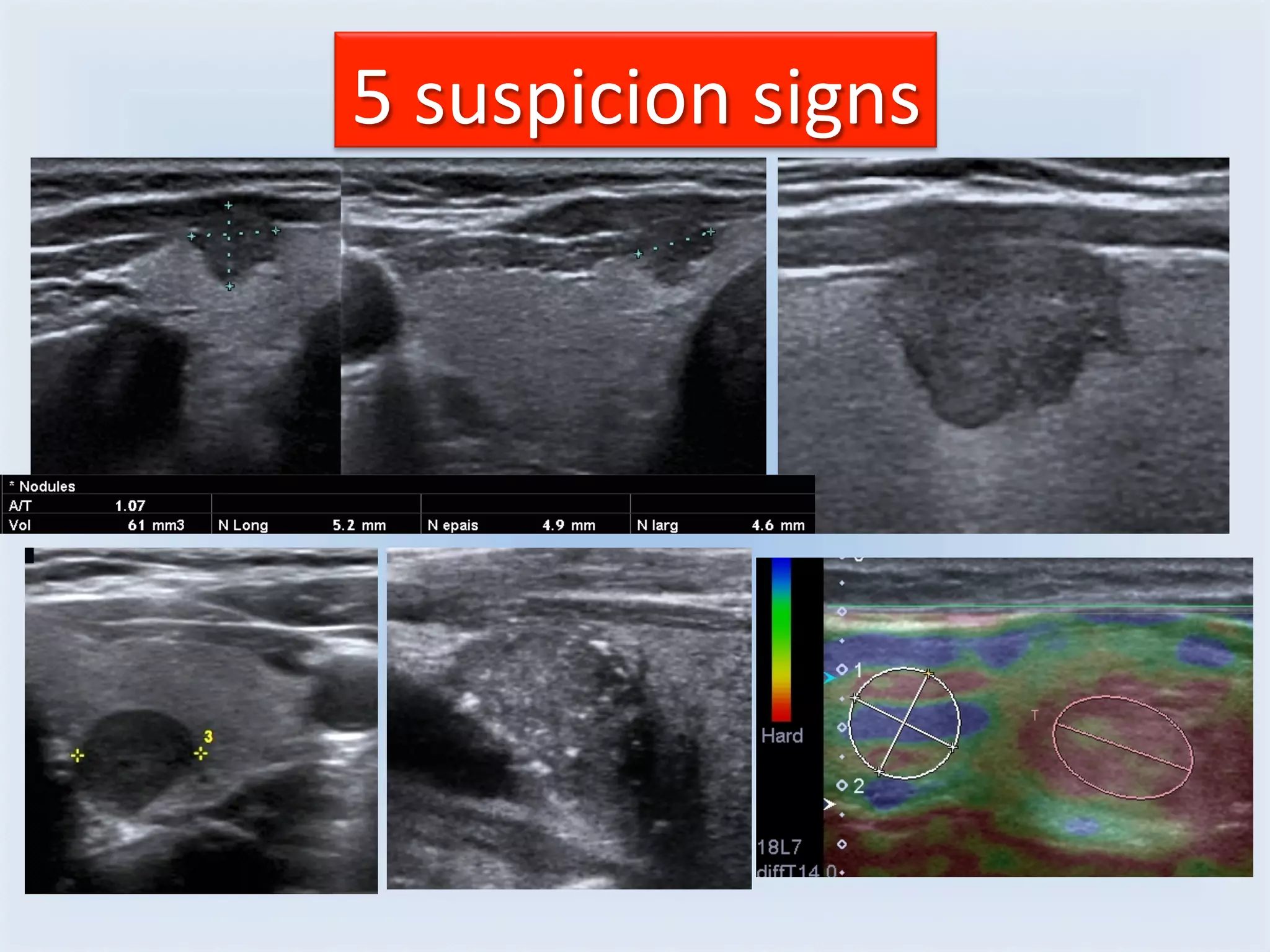 J tramalloni thyroid tirads classification practical applications jfim ...