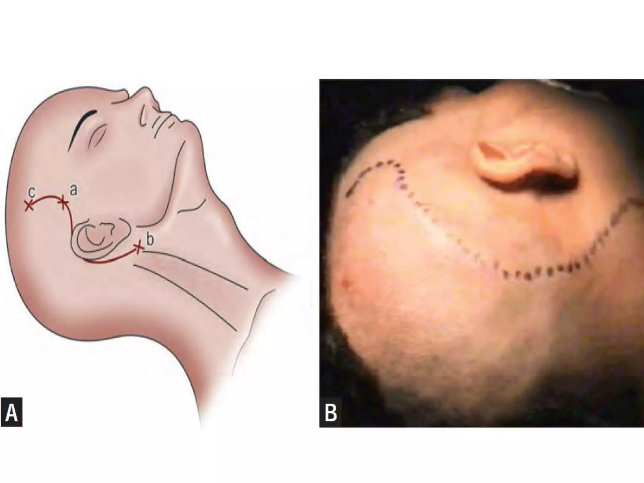 Jugular foramen anatomy and approaches | PPTX