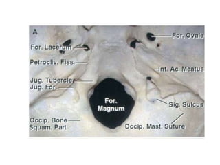 Jugular foramen anatomy and approaches | PPTX