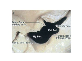 Jugular foramen anatomy and approaches | PPTX