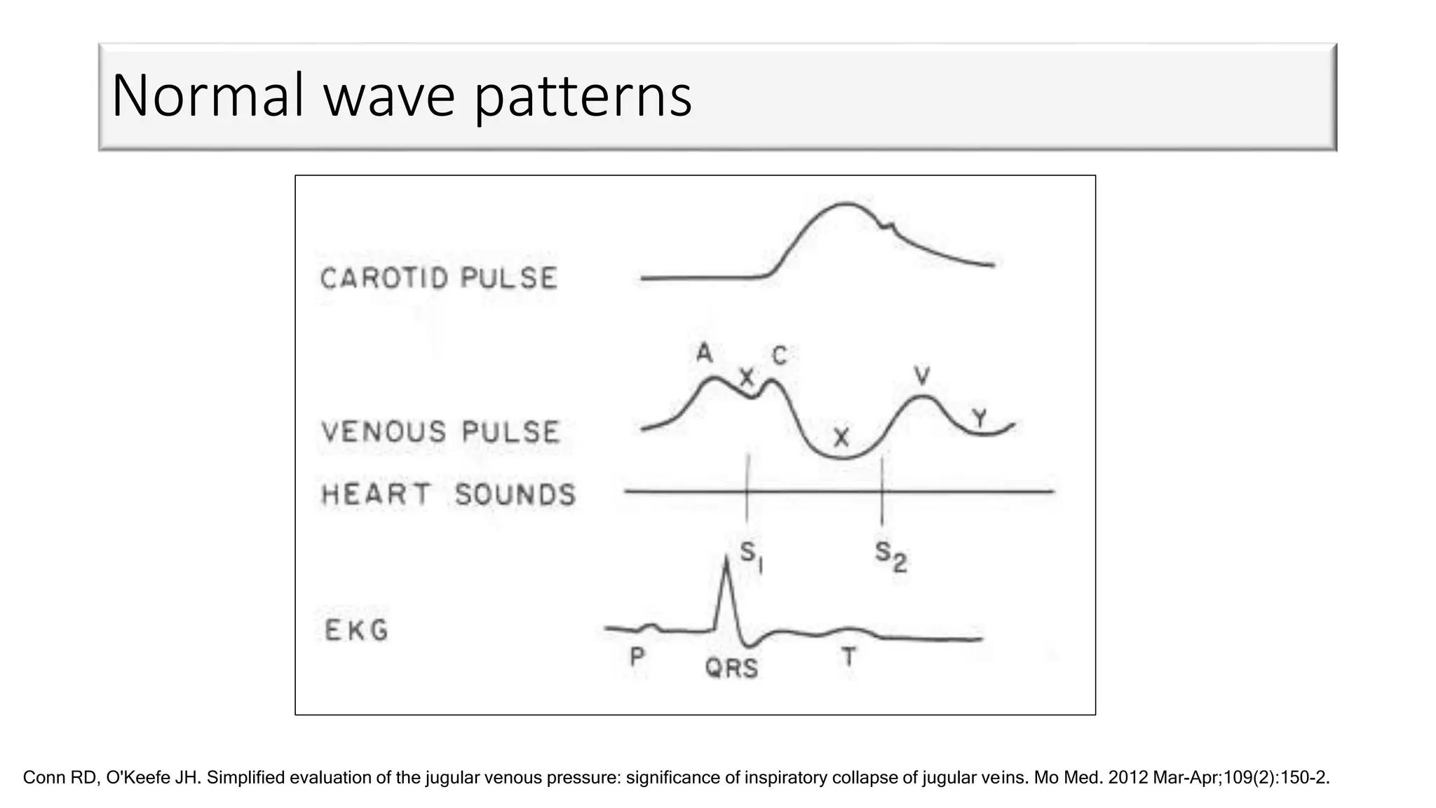 Jugular venous pressure | PPTX | Heart and Cardiovascular Diseases ...