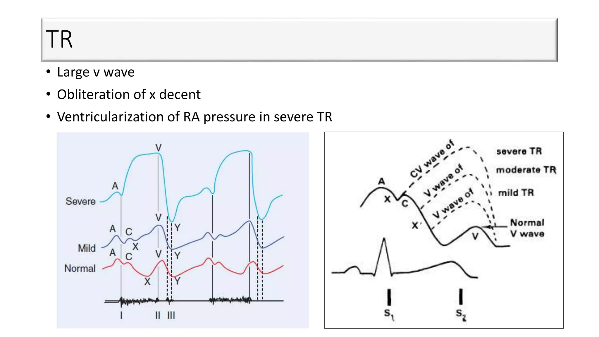 Jugular venous pressure | PPTX | Heart and Cardiovascular Diseases ...