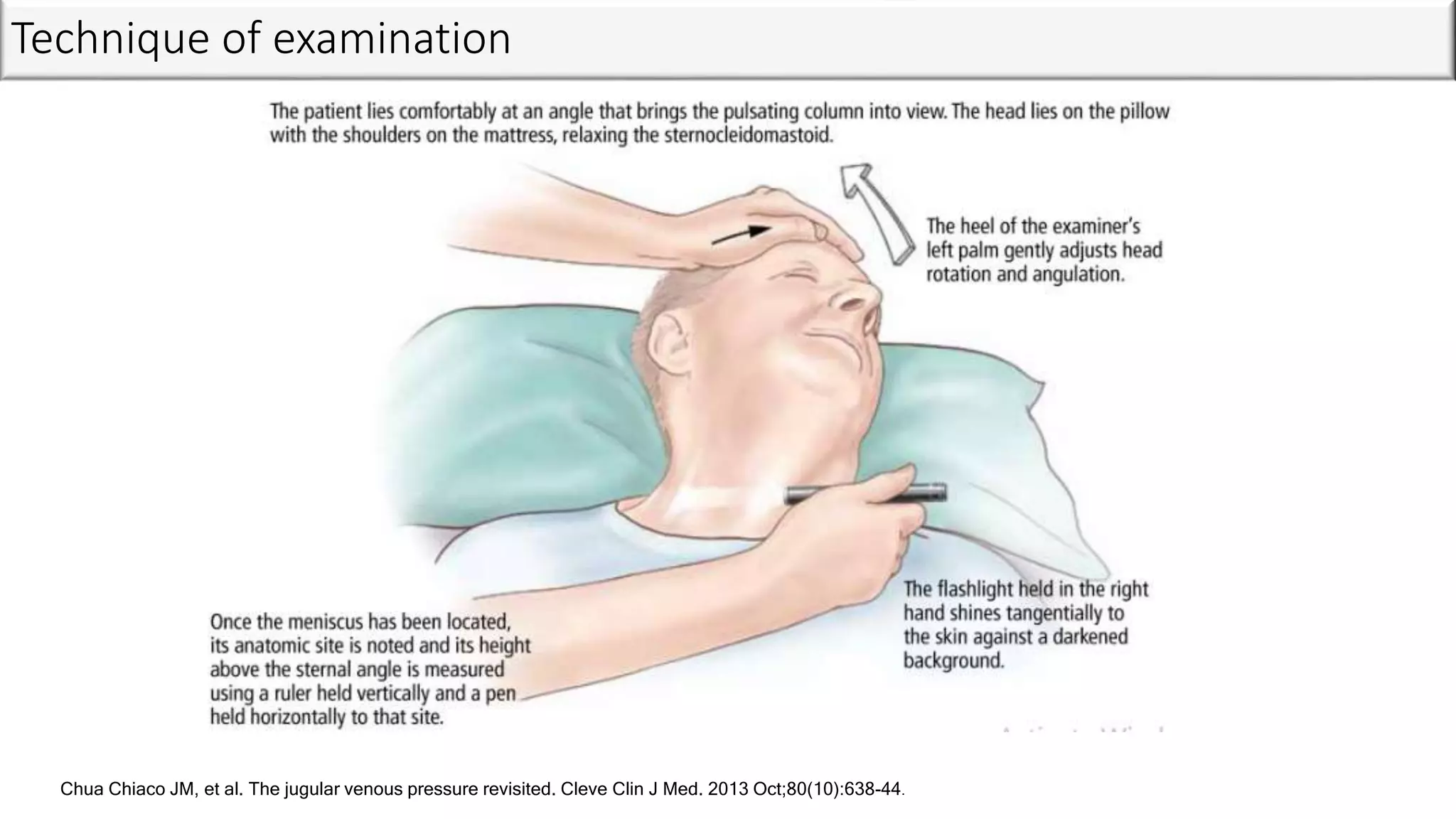 Jugular venous pressure | PPTX | Heart and Cardiovascular Diseases ...