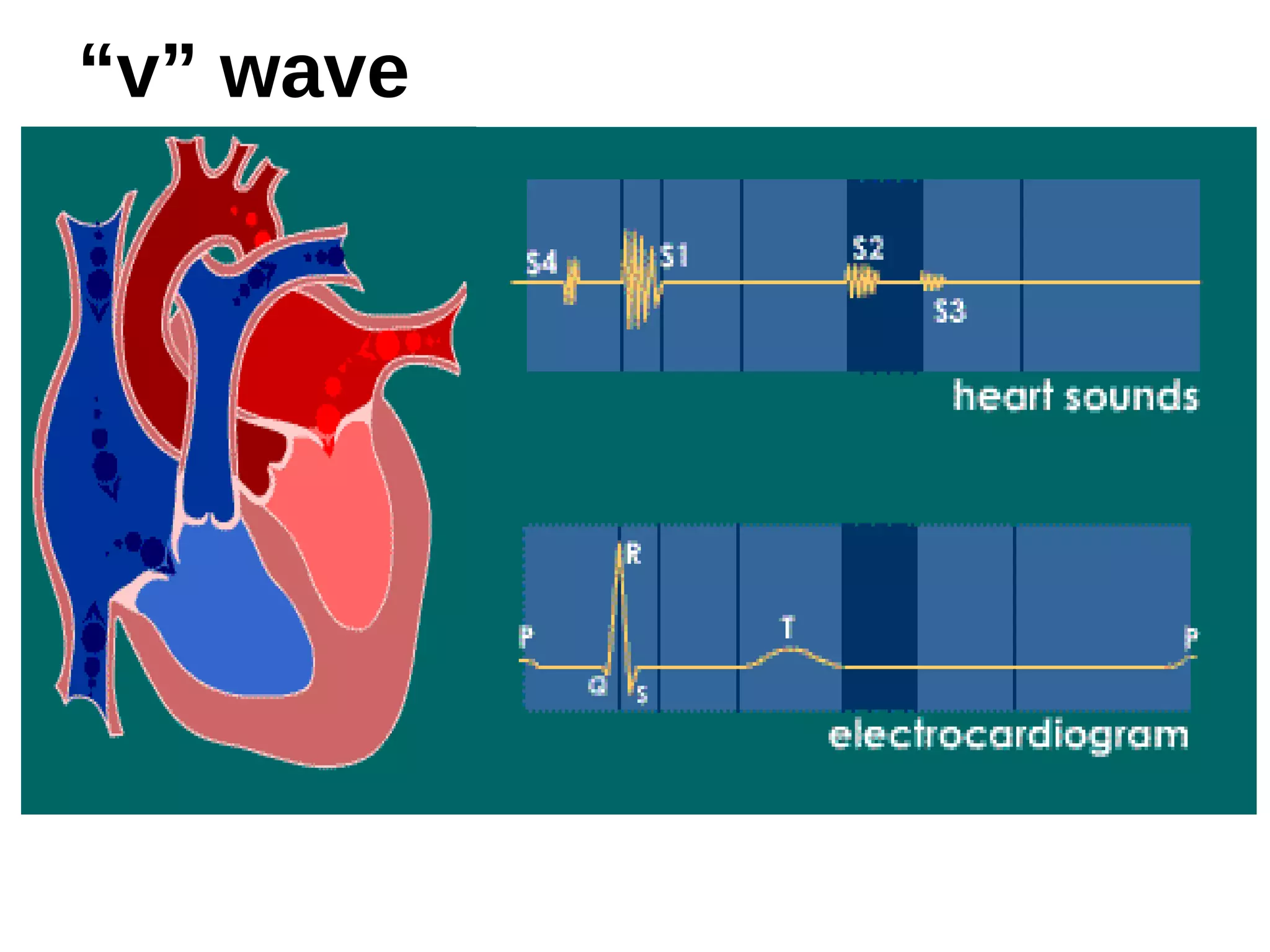 Jugular Venous Pressure (JVP) Jugular Venous Pulse | PPT