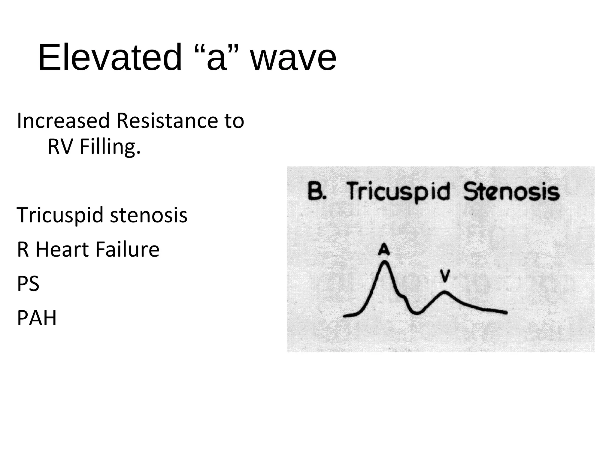 Jugular Venous Pressure (JVP) Jugular Venous Pulse | PPT