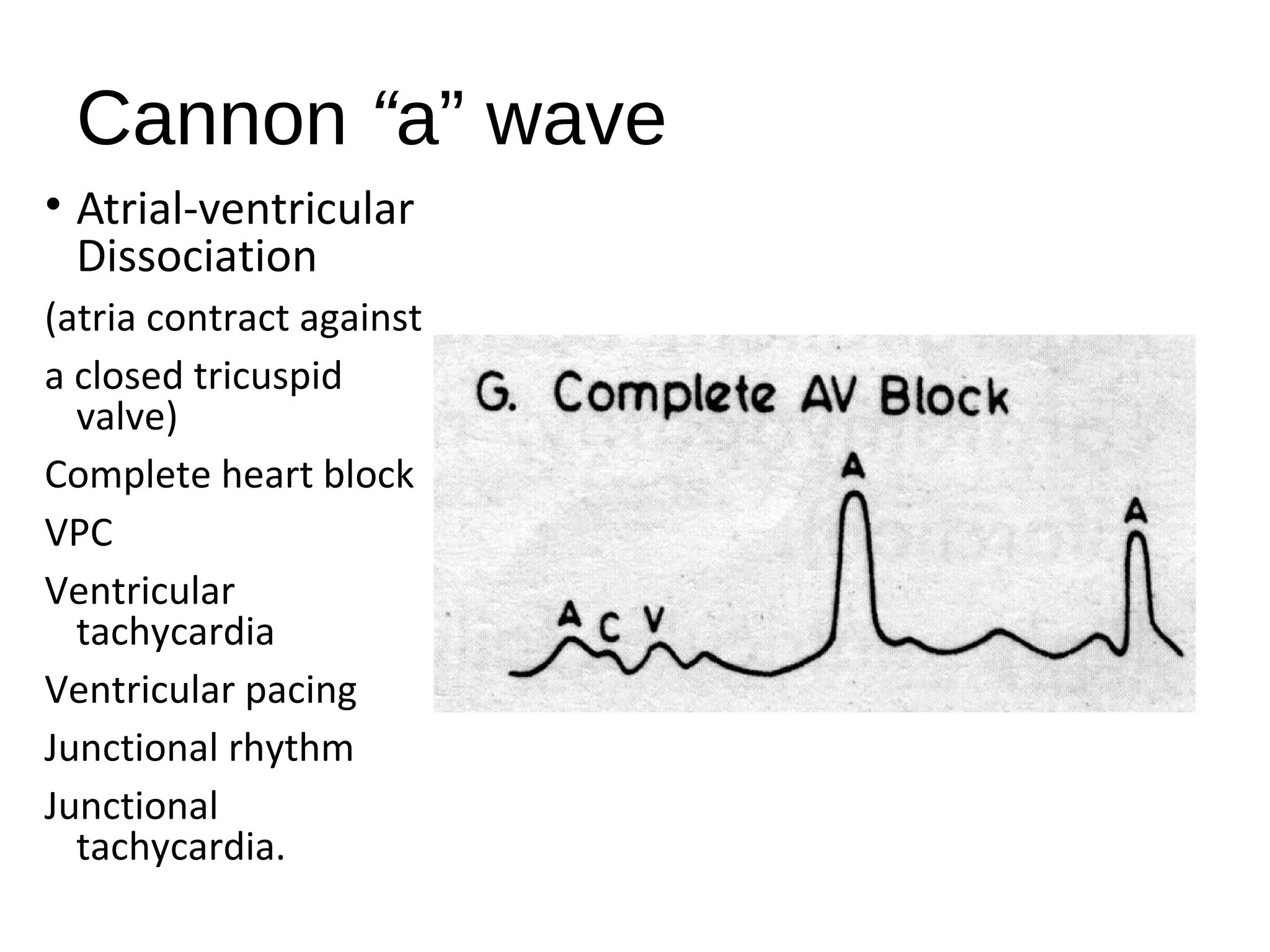 Jugular Venous Pressure (JVP) Jugular Venous Pulse | PPT