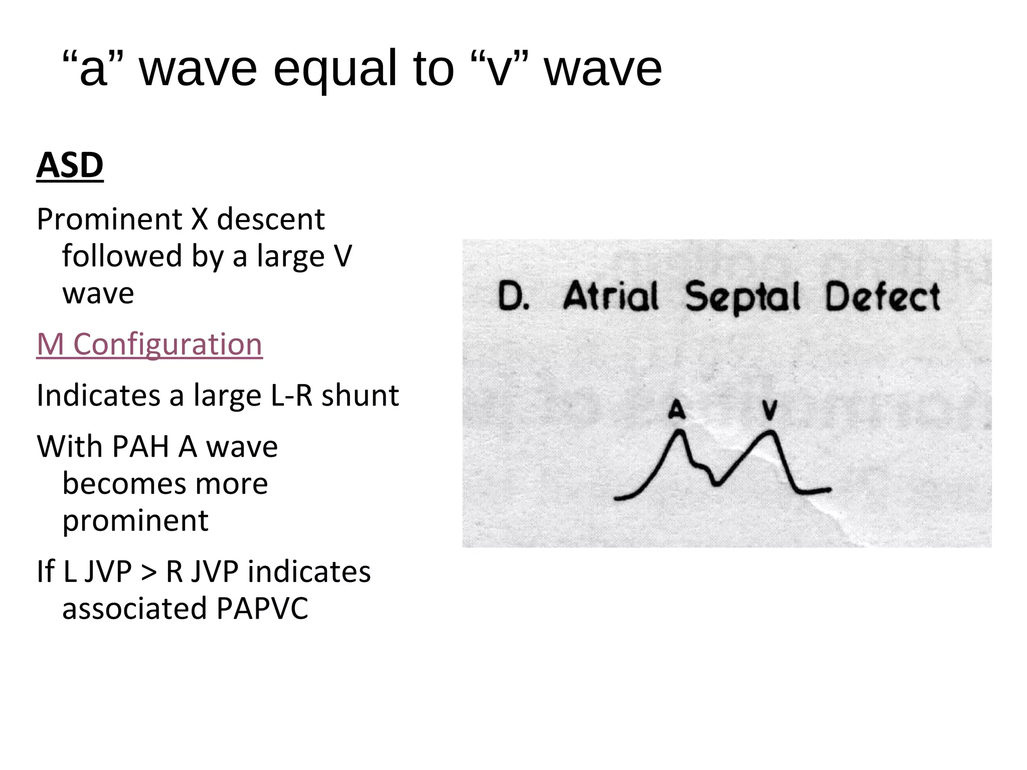 Jugular Venous Pressure (JVP) Jugular Venous Pulse | PPT