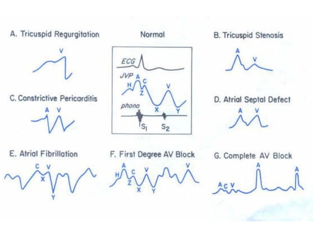 Jugular Venous Pressure (JVP) Jugular Venous Pulse | PPT