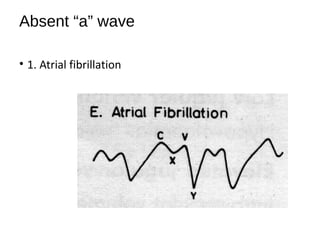 Jugular Venous Pressure (JVP) Jugular Venous Pulse | PPT