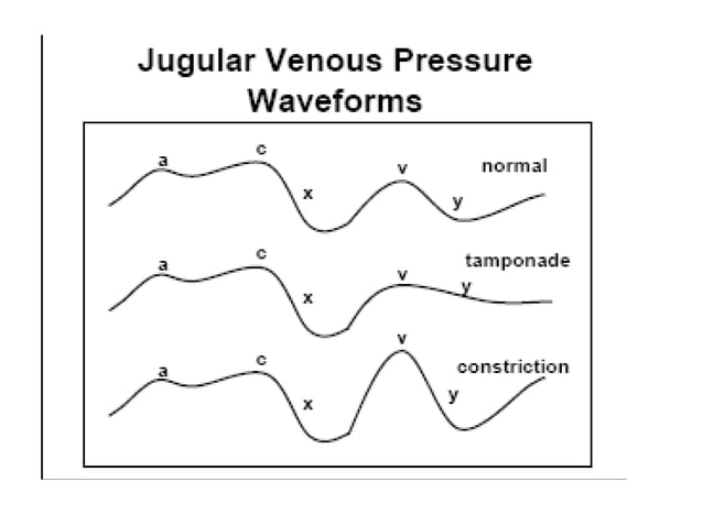 Jugular Venous Pressure (JVP) Jugular Venous Pulse | PPT