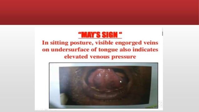 Jugular Venous Pressure jvp.pptx