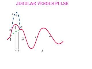 JUGULAR VENOUS PULSEObserved in Right Internal Jugular Vein | PPT