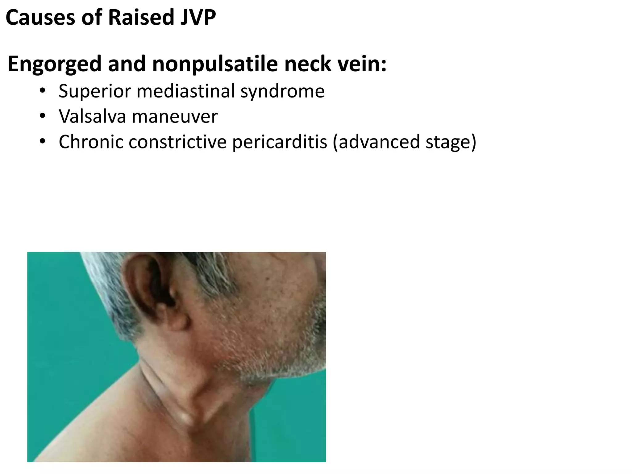Jugular Venous Pulse (JVP).pptx