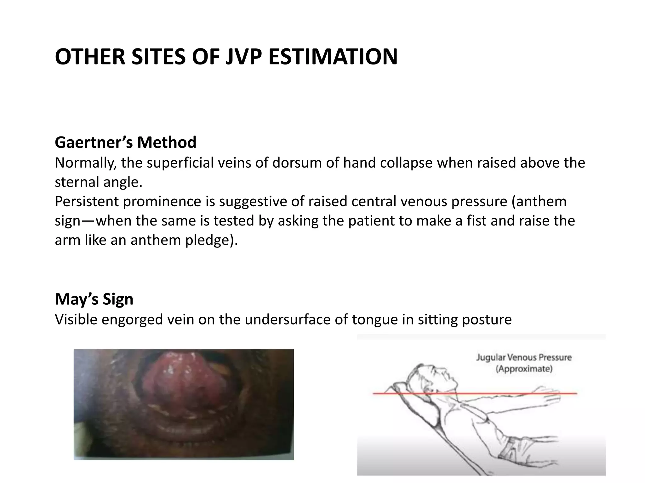 Jugular Venous Pulse (JVP).pptx