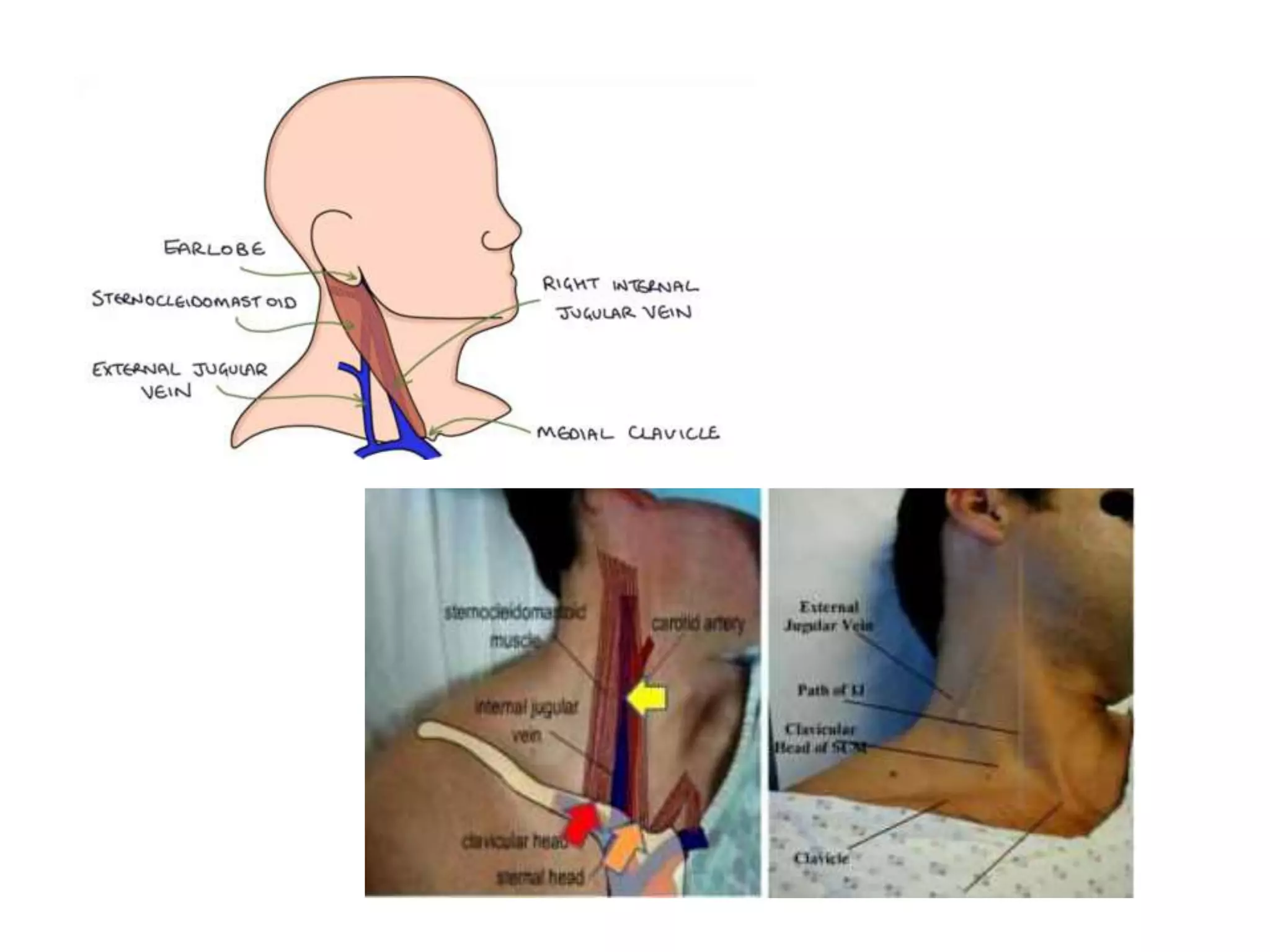 Jugular Venous Pulse (JVP).pptx