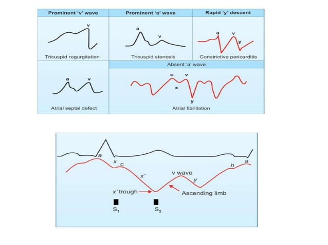 Jugular Venous Pulse (JVP).pptx