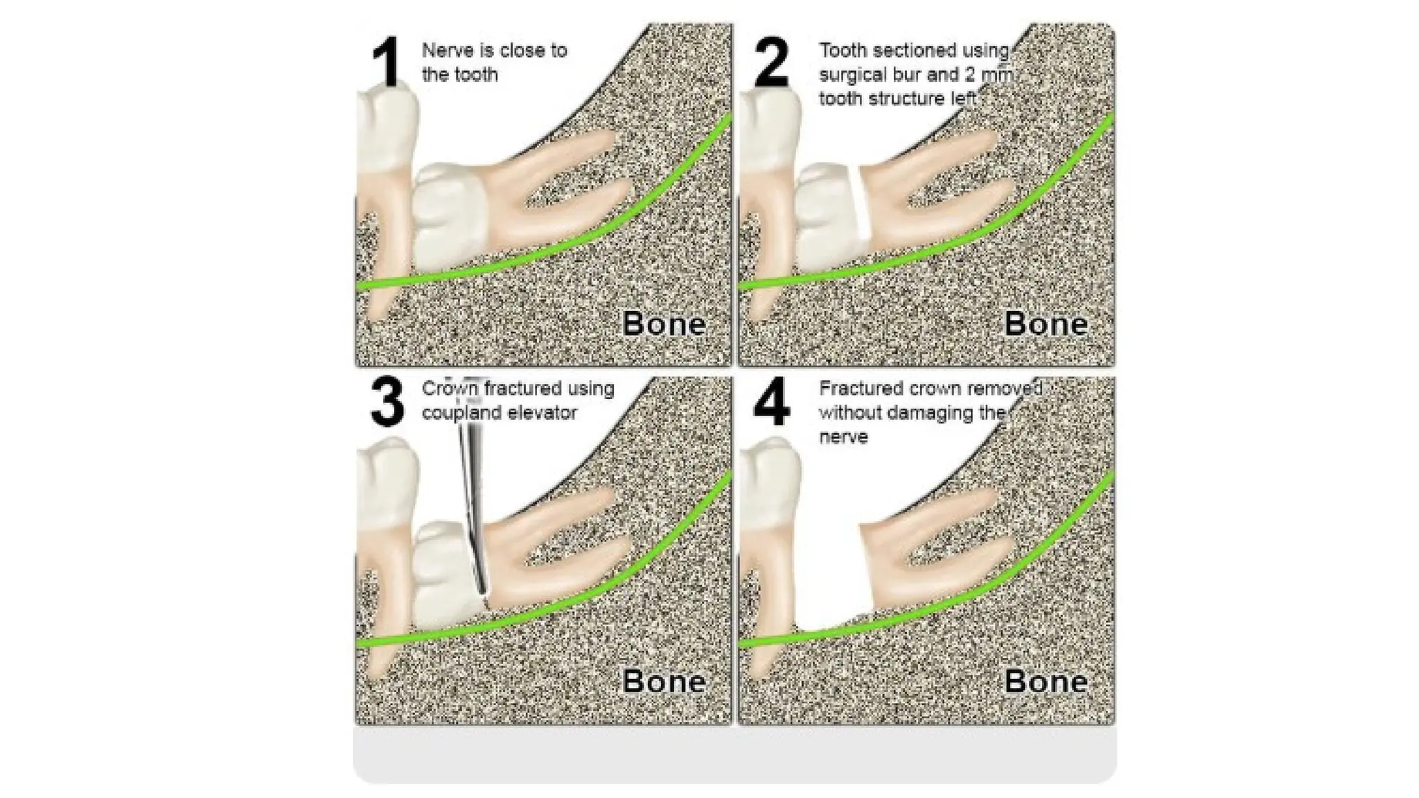 third molar surgery's in maxillofacial region | PPTX