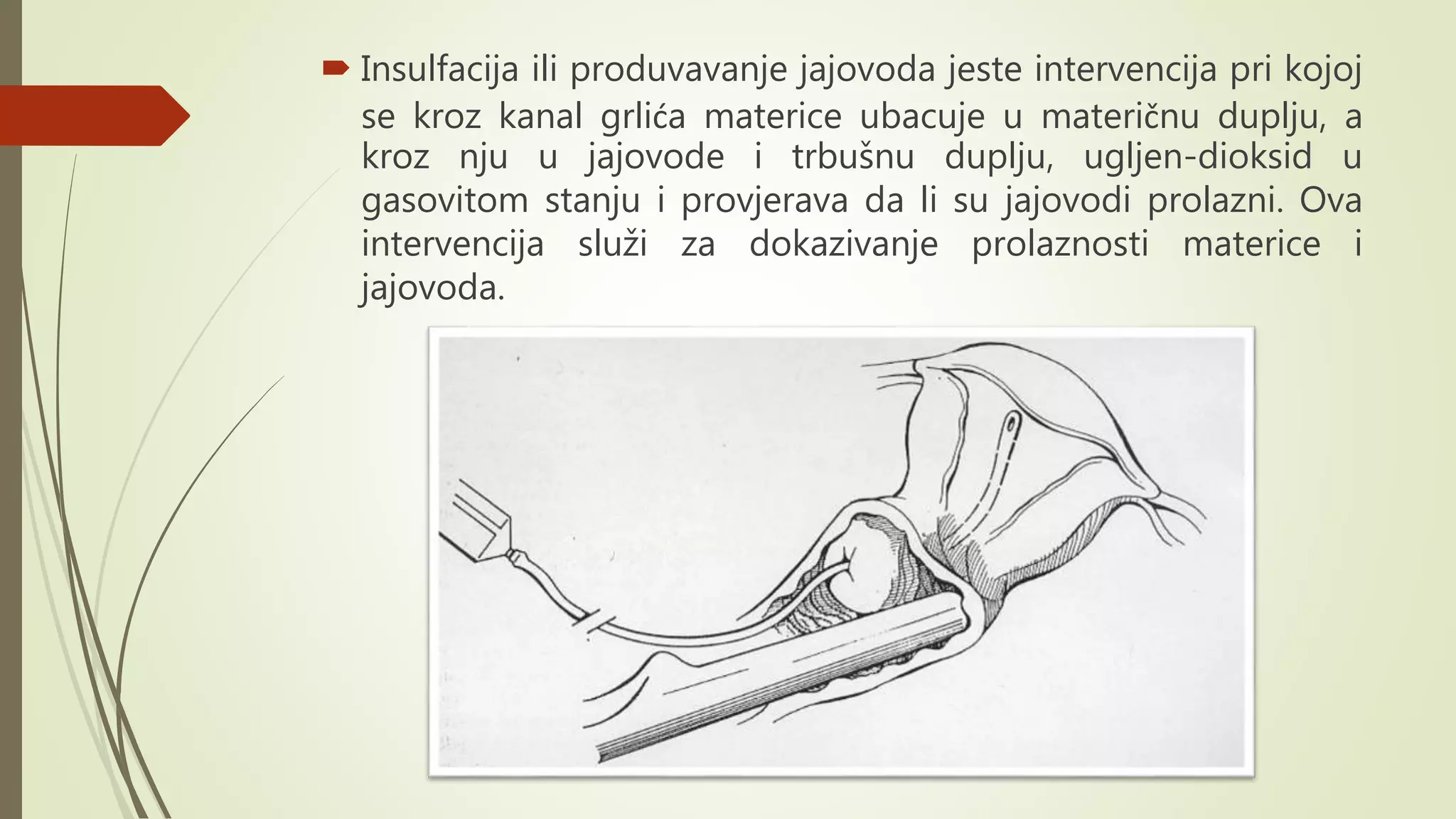 Insuflacija jajovoda | PPTX