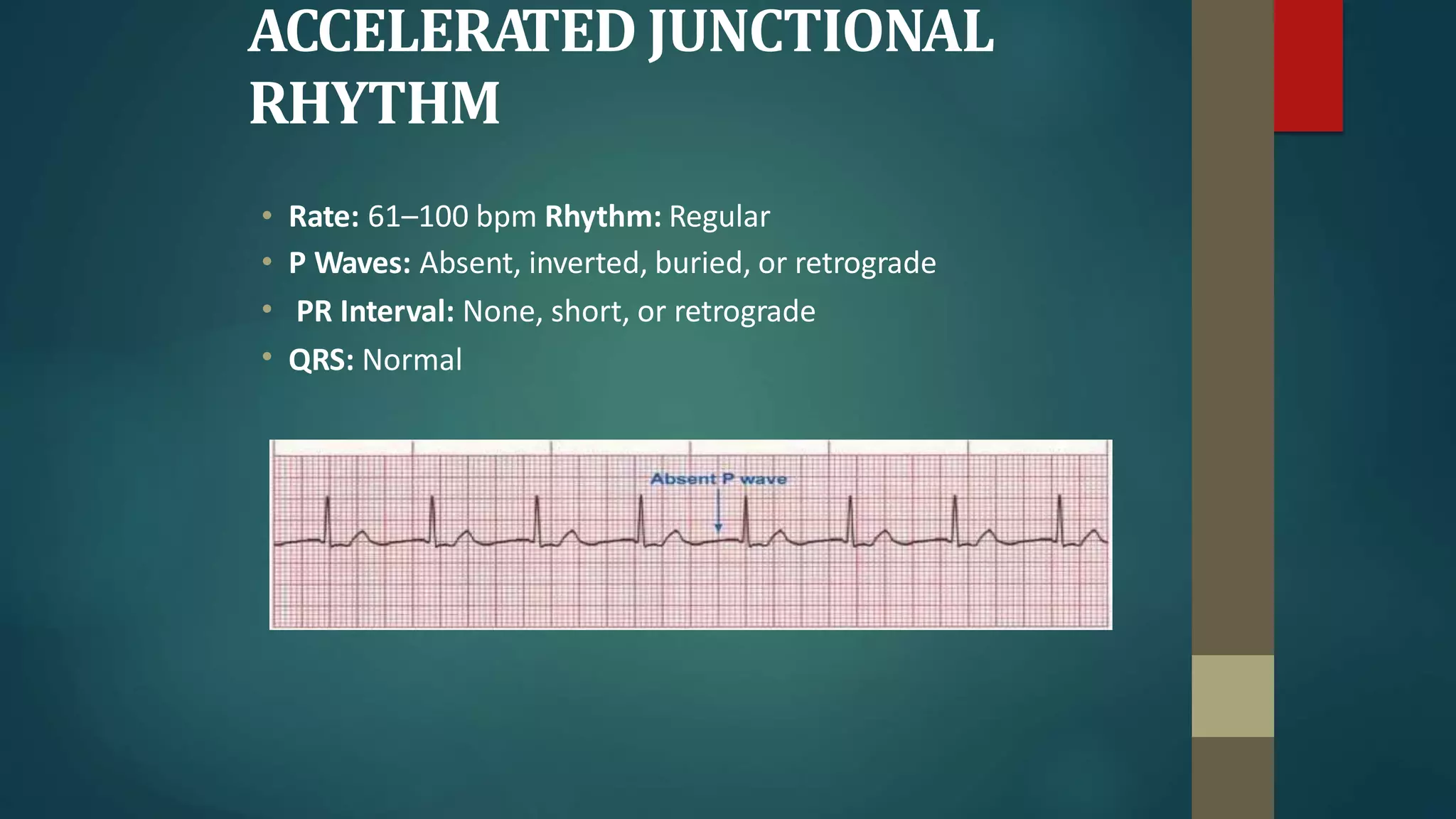 Junctional arrhythmias | PPTX | Heart and Cardiovascular Diseases ...